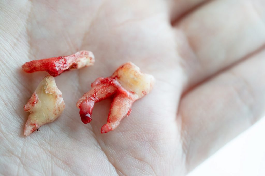 Broken wisdom tooth | Dr. Gibberman - Center for Esthetic Dentistry