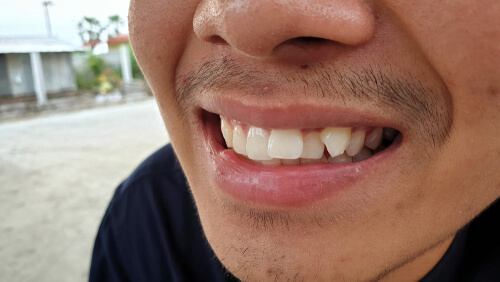 Composite Bonding on Overlapping Teeth: A Modern Solution for a Perfect ...